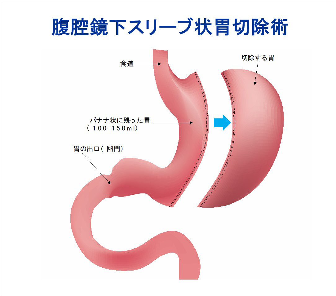 肥満減量外科治療について | 治療法の紹介 | 浜松医科大学 外科学第二講座 | 浜松医科大学 第二外科医局 外科専門医をめざそう！