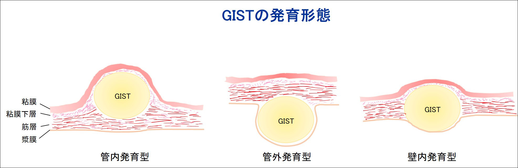 GIST（消化管間質腫瘍）について① | 治療法の紹介 | 浜松医科大学 外科学第二講座 | 浜松医科大学 第二外科医局 外科専門医をめざそう！
